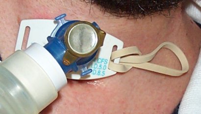 How to secure the vent tube to the trach